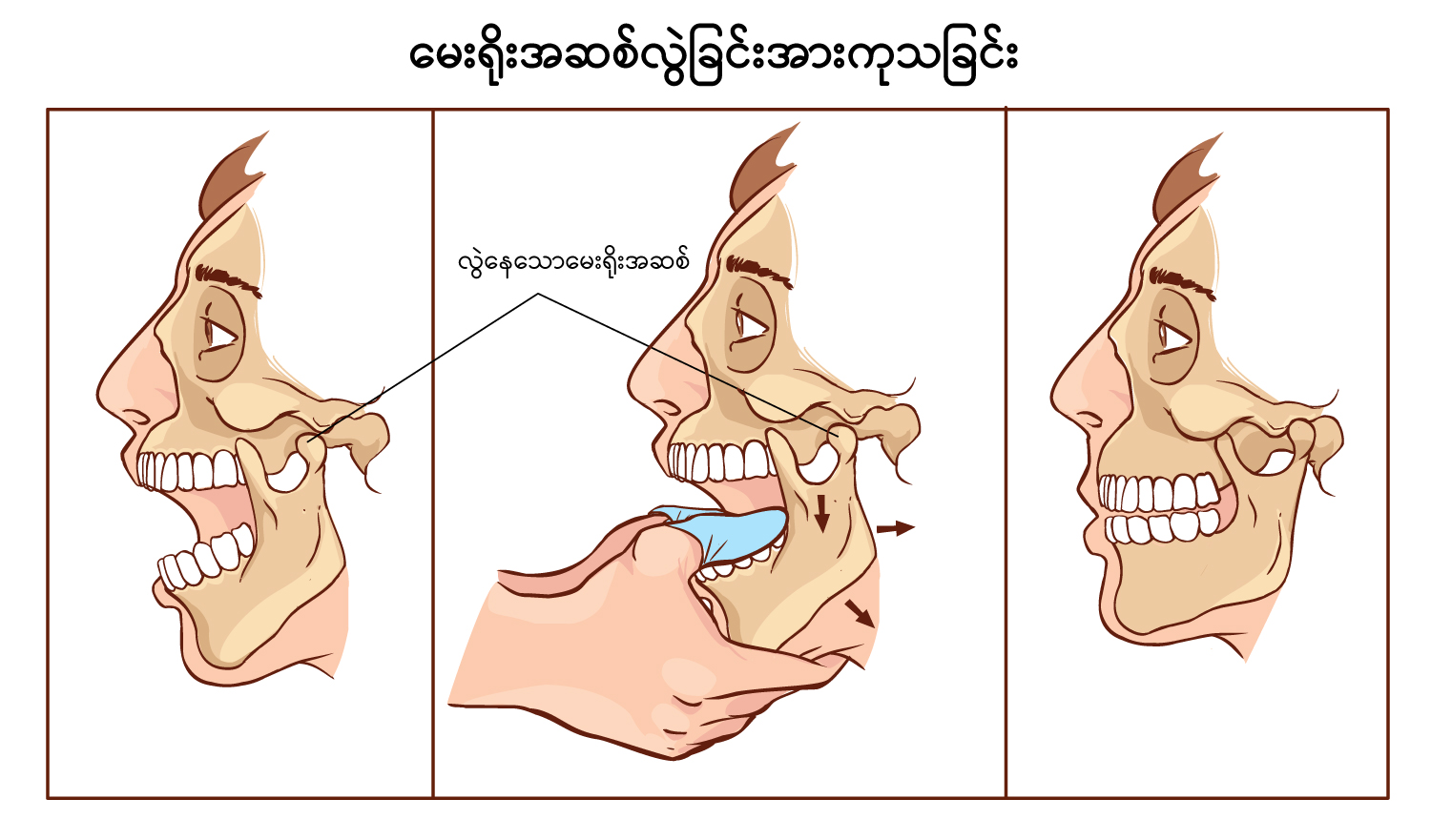 Jaw dislocation and jaw fracture (မေးရိုးအဆစ်လွဲခြင်းနှင့်မေးရိုးကျိုးခ ...