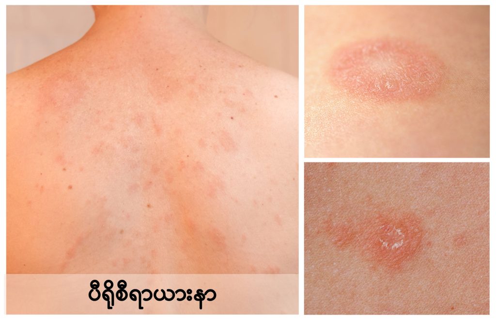 Pityriasis rosea (ပီရိုစီရာ ယားနာ) - CLL HEALTH