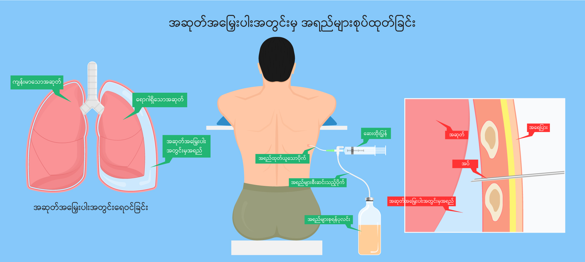 Thoracocentesis – pleural aspiration/pleural tap (အဆုတ်အမြှေးပါးအတွင်းမ ...