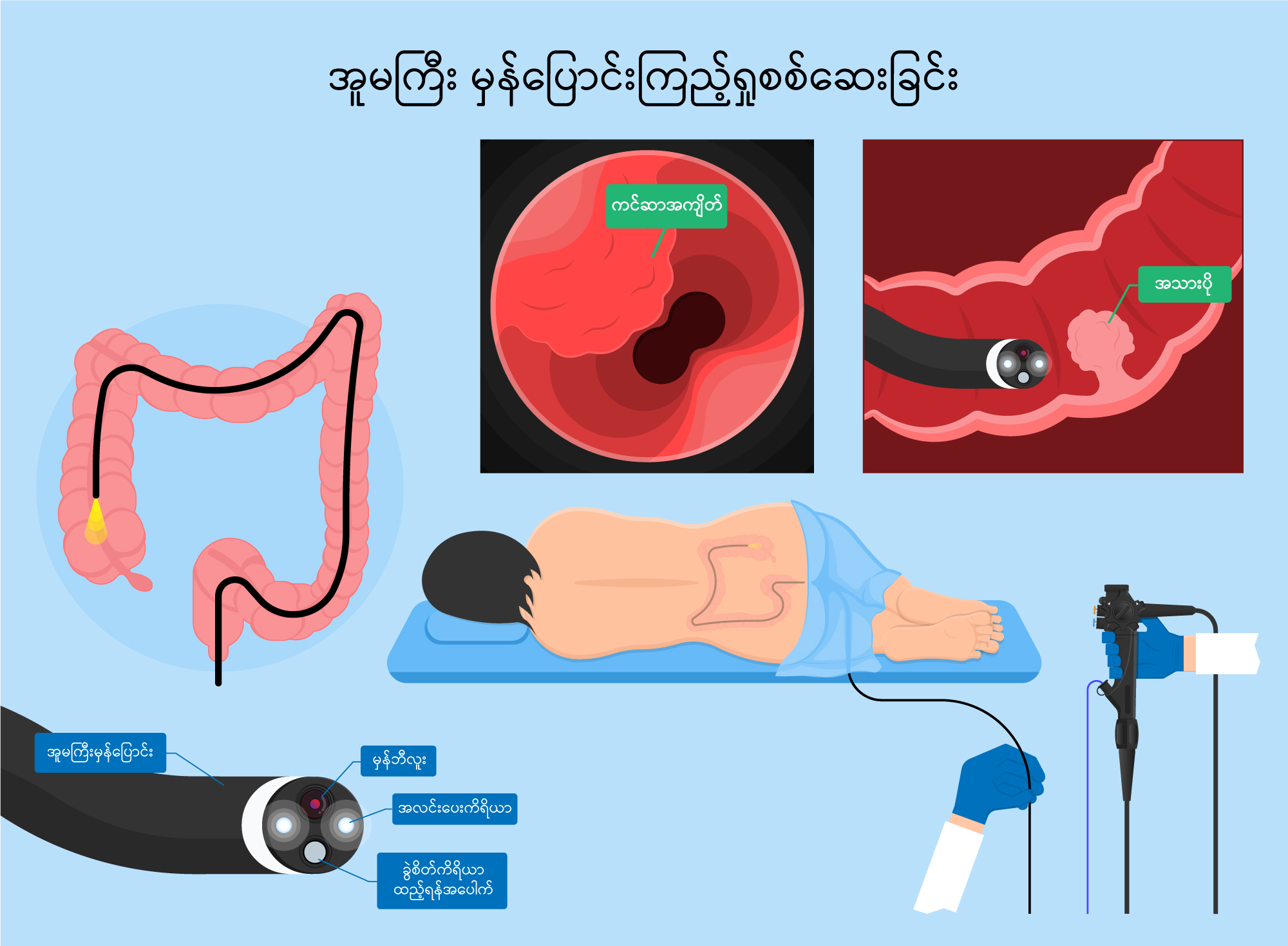 Colonoscopy (အူမကြီး မှန်ပြောင်းကြည့်ရှုစစ်ဆေးခြင်း) - CLL HEALTH