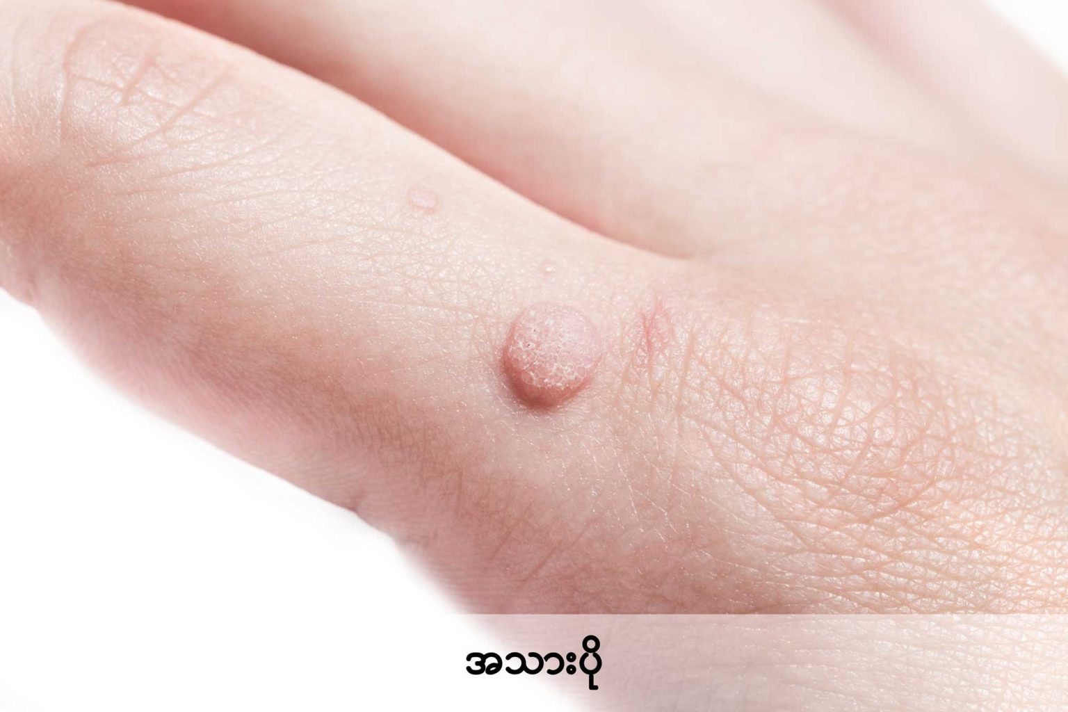 Warts (ကြွက်နို့များ) - CLL Health