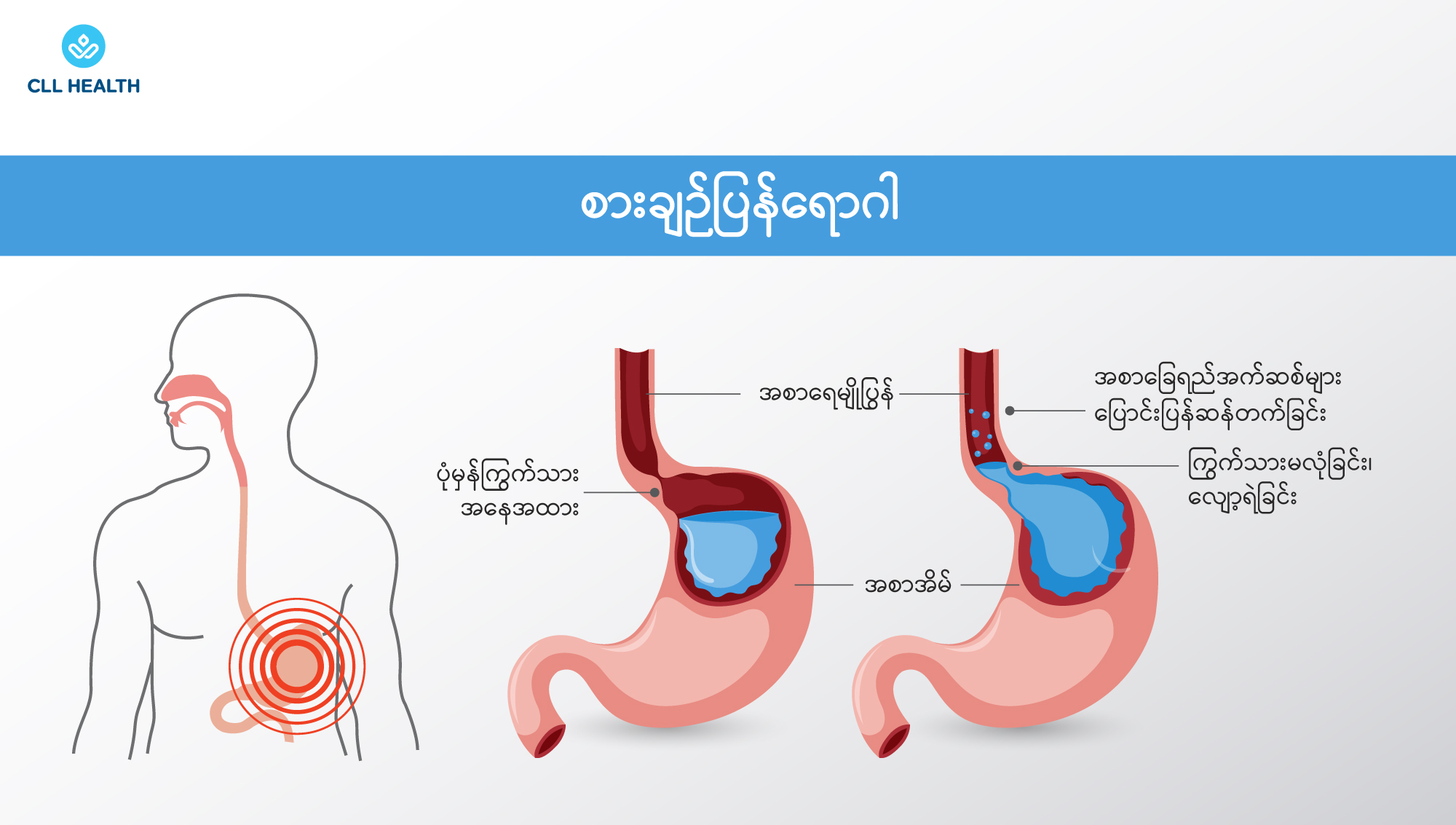 Gastroesophageal Reflux Disease - GERD (စားချဉ်ပြန်ရောဂါ) - CLL HEALTH