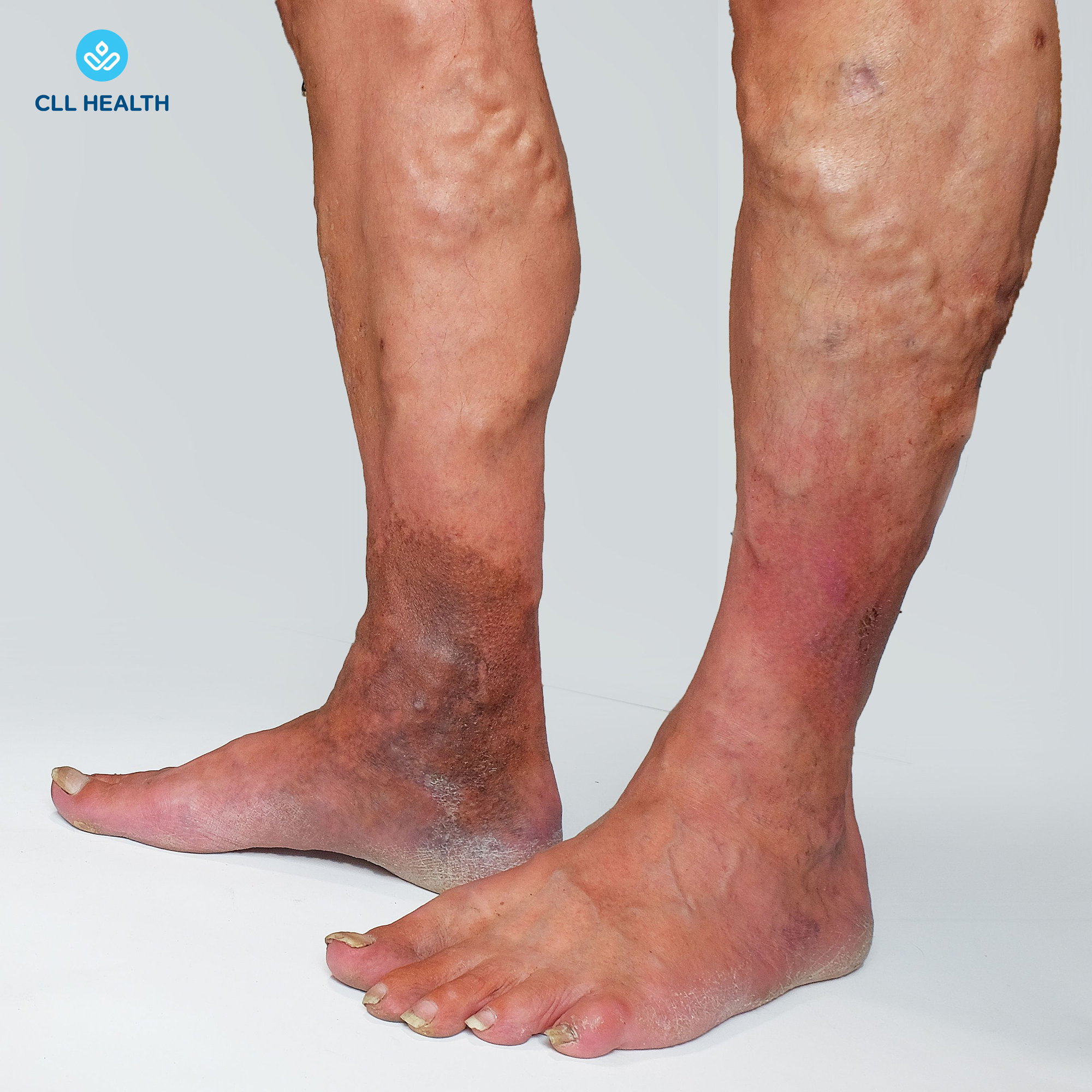 Varicose Veins of Lower Limb (ခြေထောက်သွေးပြန်ကြောထုံးခြင်း) - CLL HEALTH